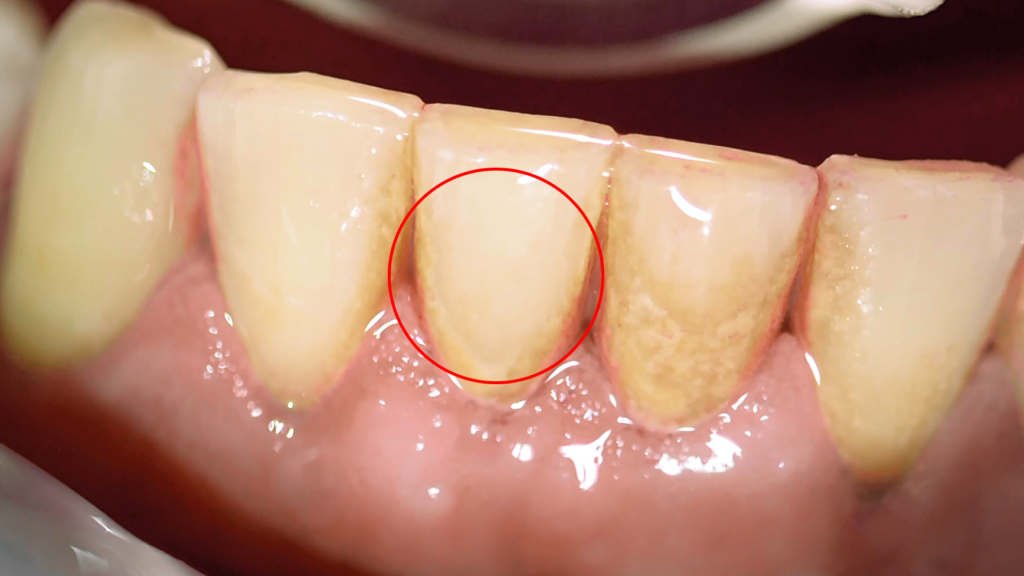 GBT 04 AIRFLOW® MAX - EMS - AIRFLOW® Dental Spa