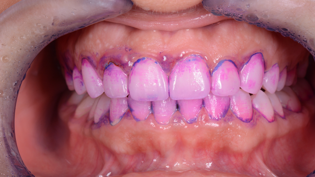 Biofilm Discloser | AIRFLOW® Dental Spa
